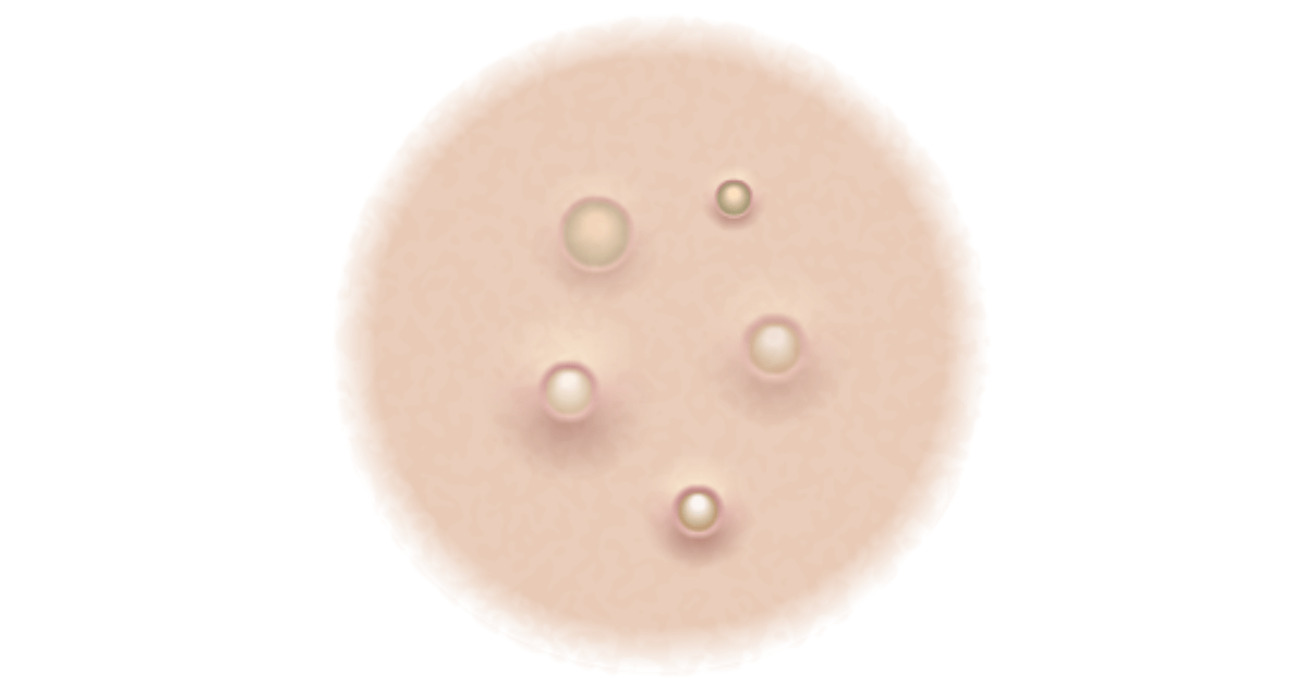 Common Skin Conditions - Southern Dermatology